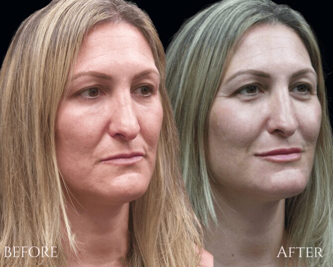 RHA Collection Filler in Manhattan & Great Neck, NY | Aristocrat ...