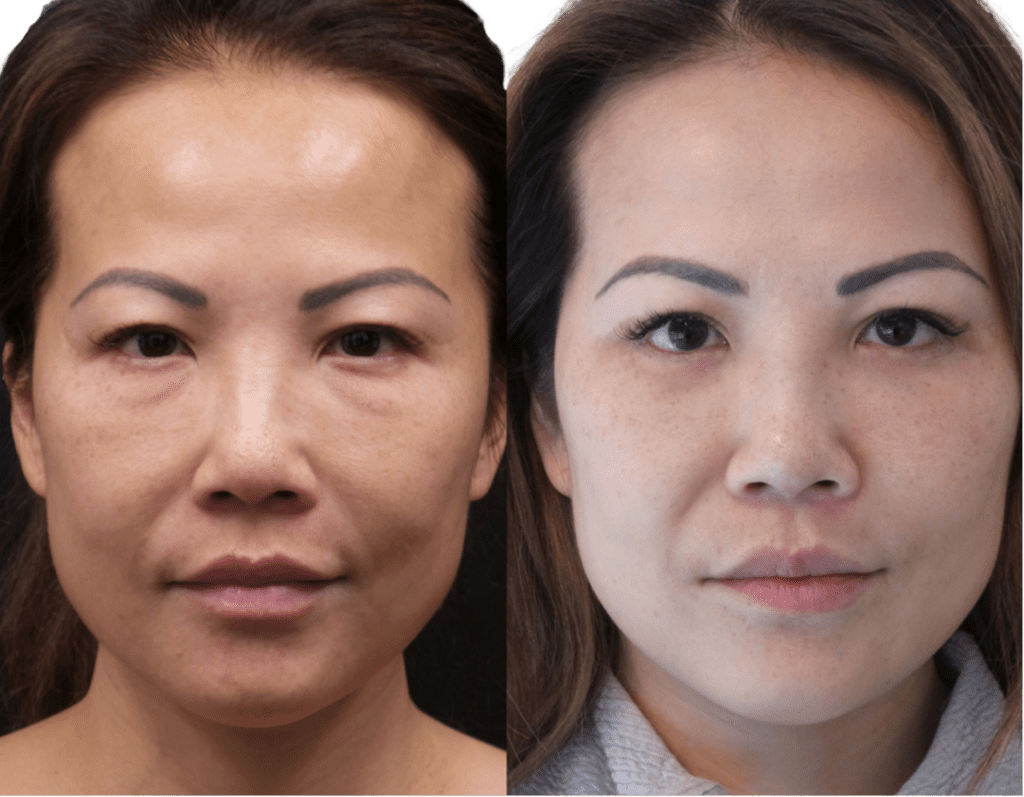 Nano Fat Injections – Aristocrat Plastic Surgery