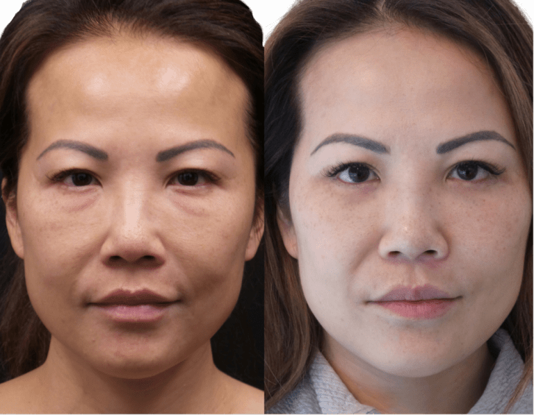 Nano Fat Injections – Aristocrat Plastic Surgery