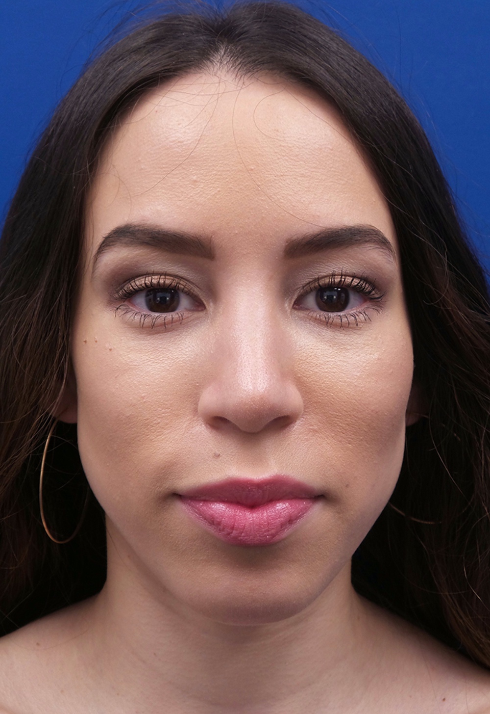 Nose Surgery - 38420 – Aristocrat Plastic Surgery