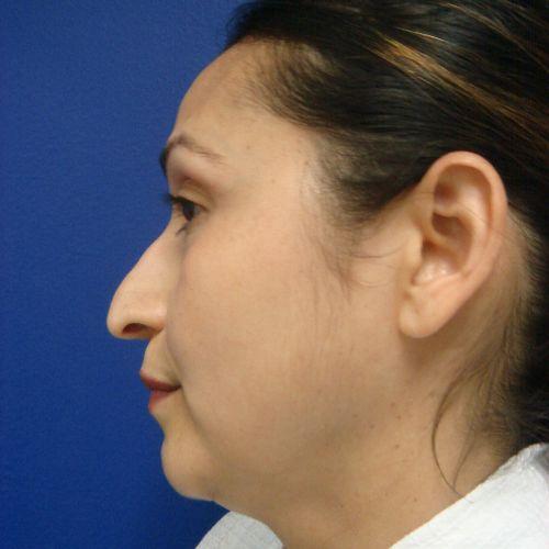 Before and After – Aristocrat Plastic Surgery