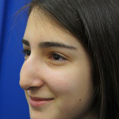 Before and After – Aristocrat Plastic Surgery